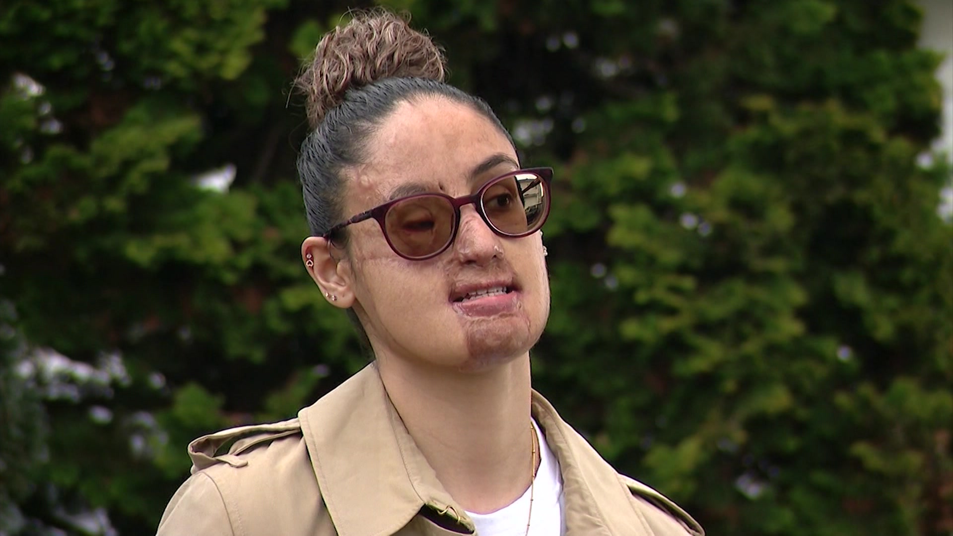 Elmont woman doused with acid in driveway reflects on 3-year ...