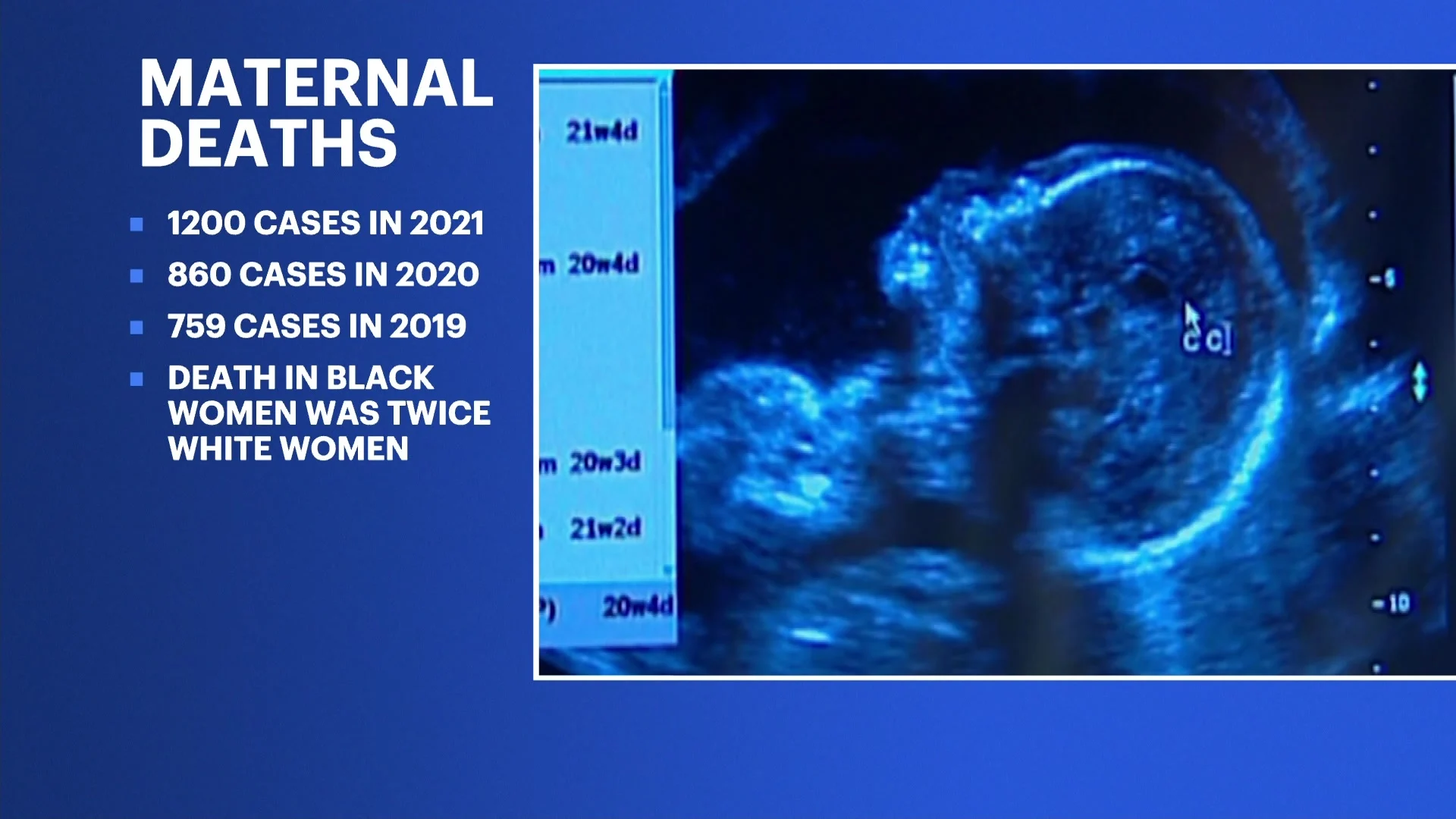 US pregnancy deaths dropped in 2022, after COVID spike US pregnancy deaths dropped in 2022, after COVID spike