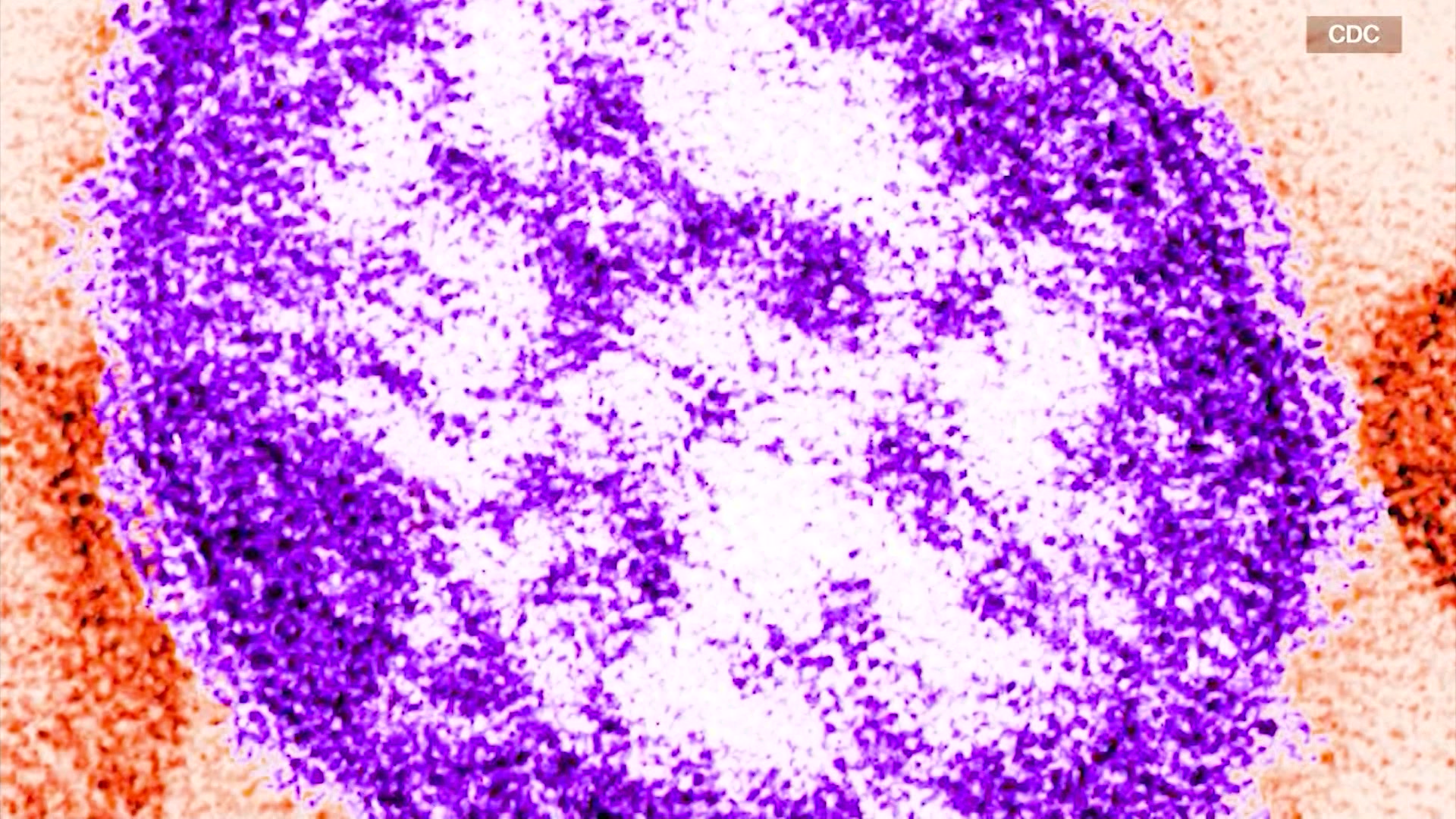 Measles case reported in Mahopac