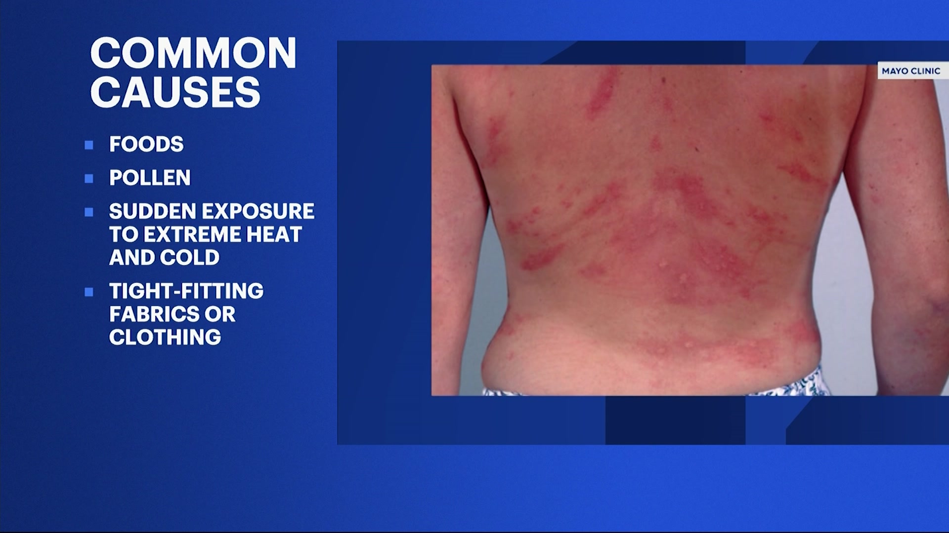 News 12 | Bronx | Seasonal Hives On The Rise Ahead Of The Summer