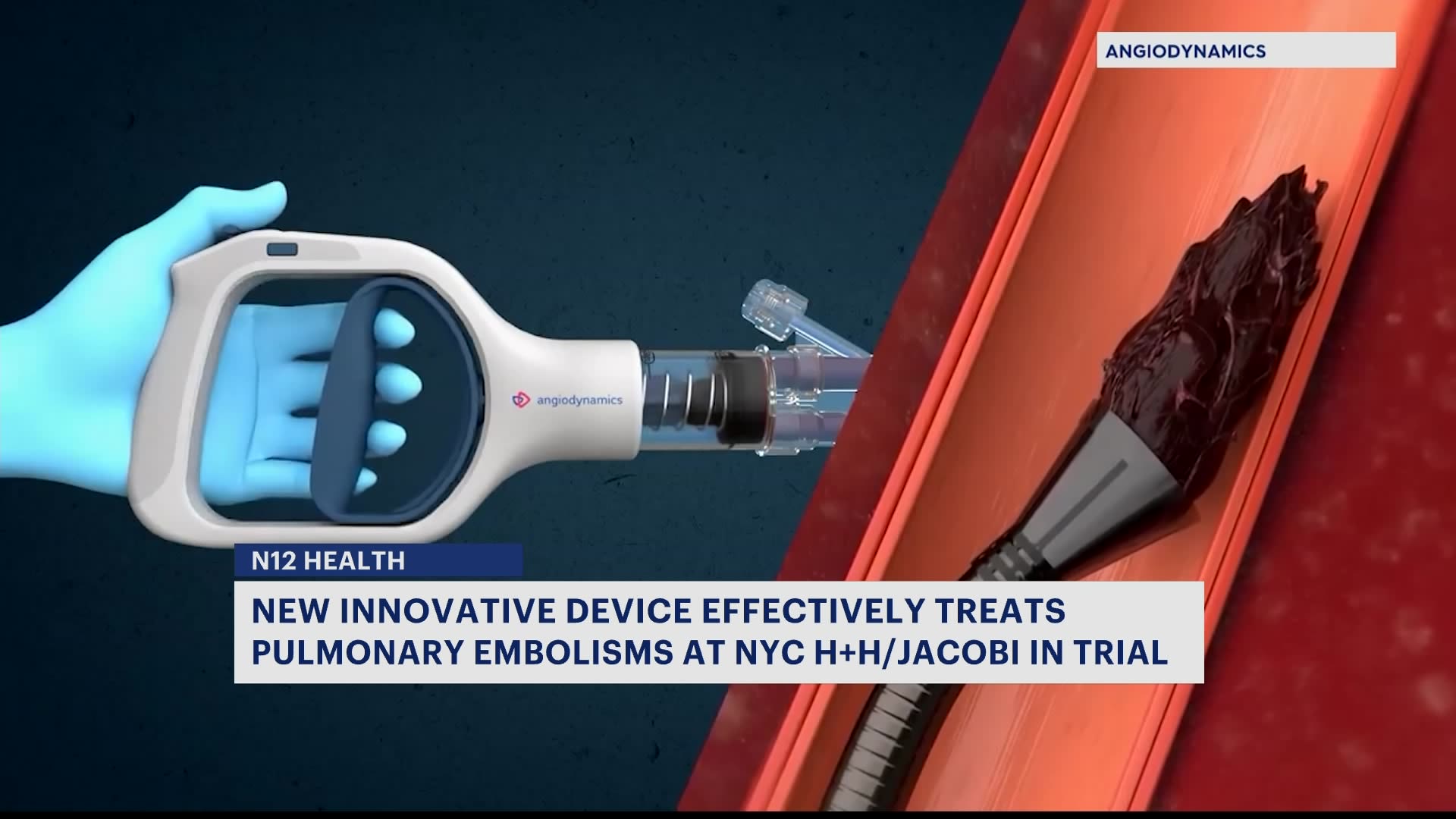 Groundbreaking tool to treat pulmonary embolisms on display at NYC ...