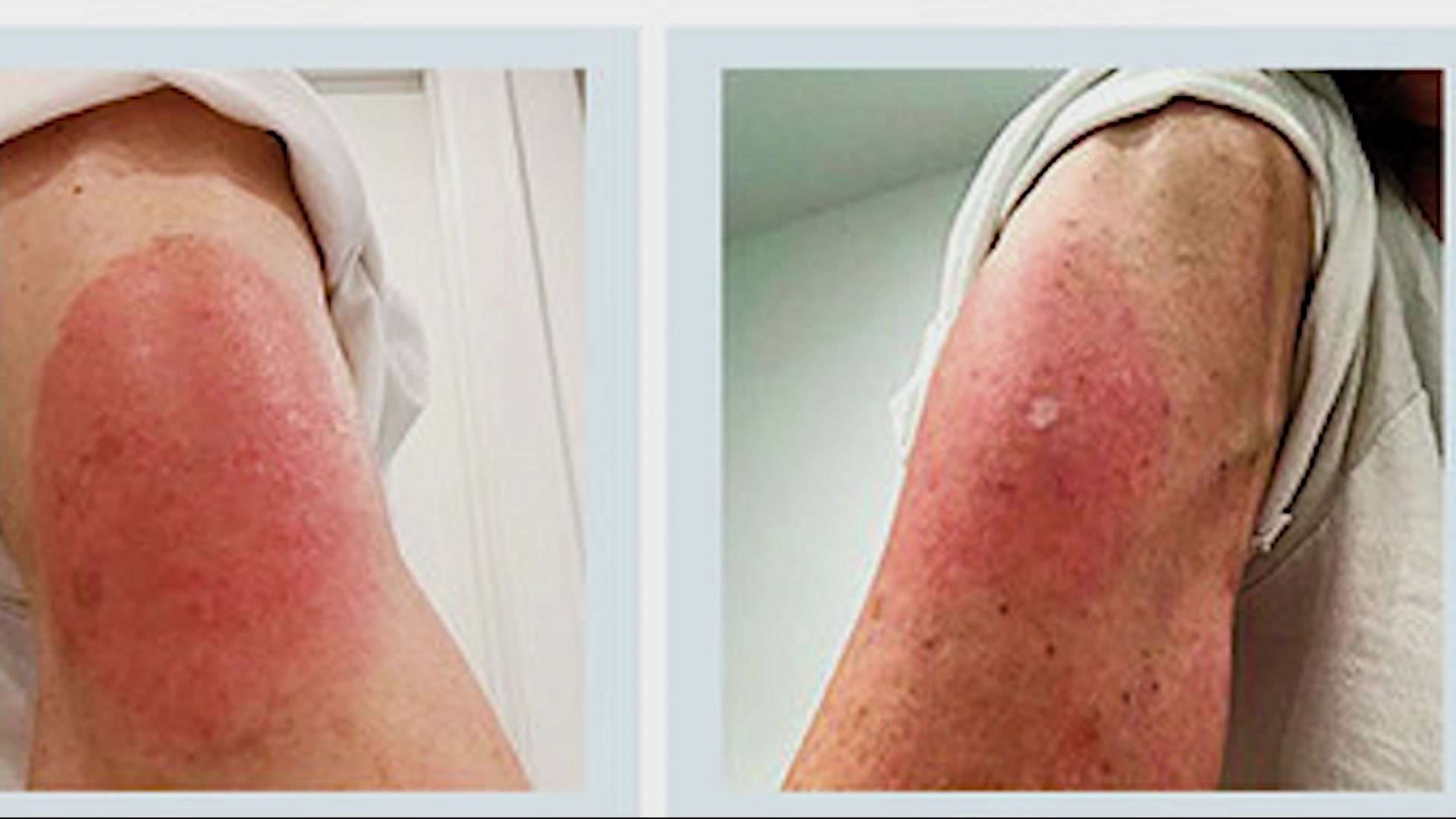 Medical experts: Rash could develop at injection site of Moderna COVID ...