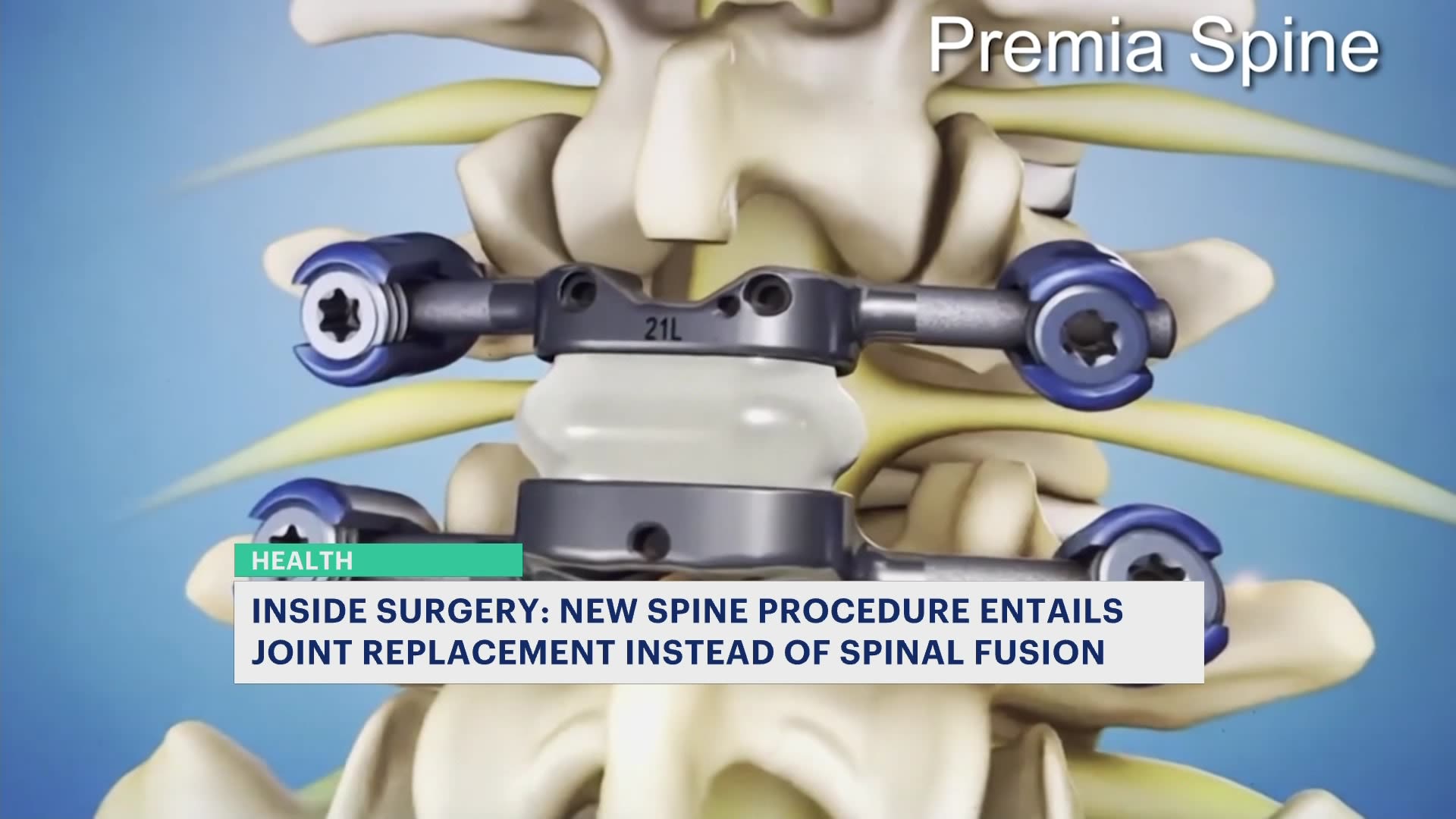 New procedure considered an alternative to spinal fusion surgery