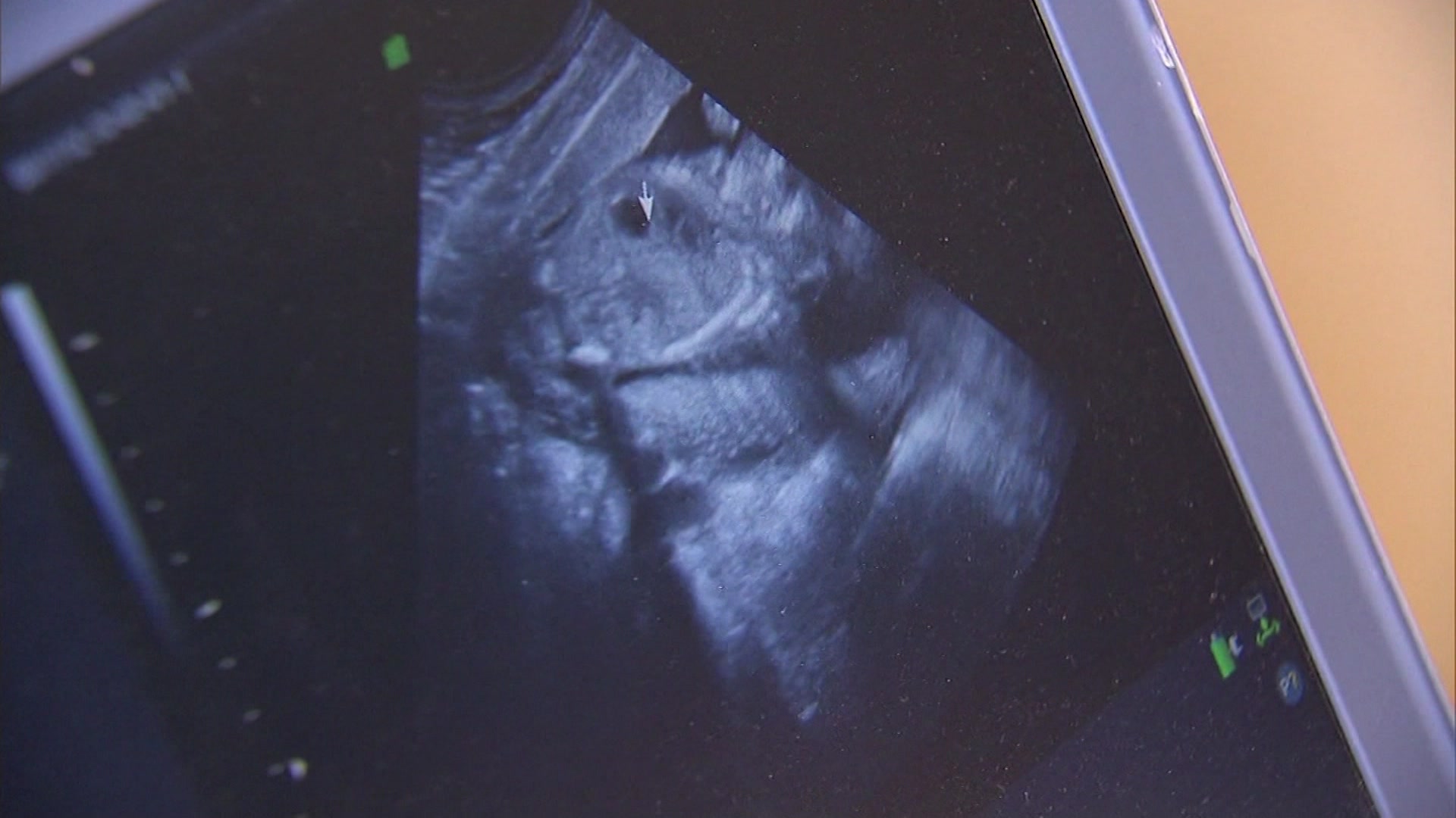 Researchers at Yale Fertility Center work on test to identify ...